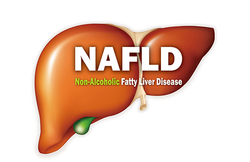 폭발적으로 늘어나는 NAFLD 위험성은?
